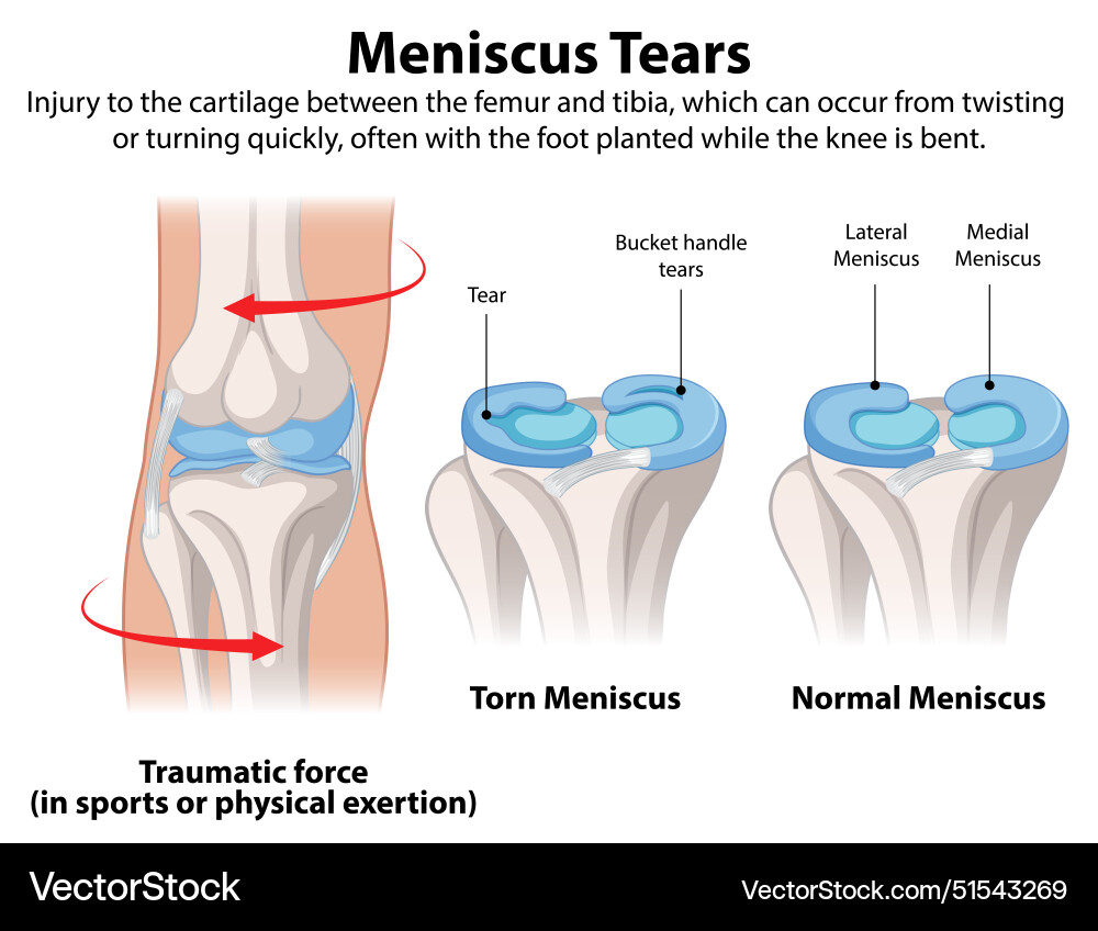 Torn and normal meniscus Royalty Free Vector Image