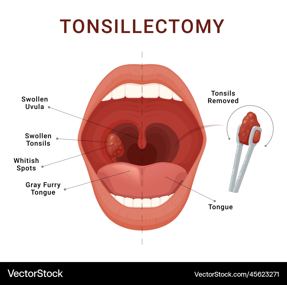 Tonsillectomy scheme removal of palatine tonsils Vector Image