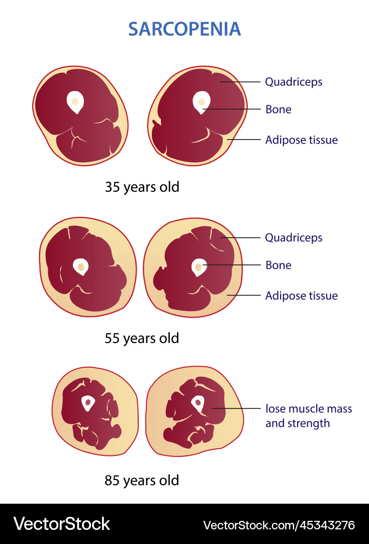 Infographic of sarcopenia Royalty Free Vector Image