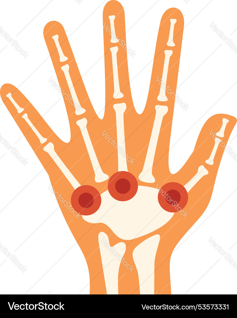 Human hand showing rheumatoid arthritis symptoms Vector Image