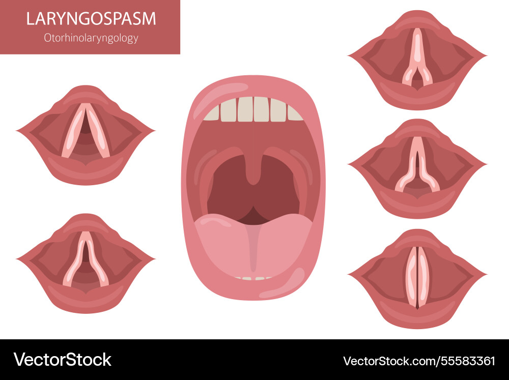 Laryngospasm Anatomy & Treatment Royalty Free Vector