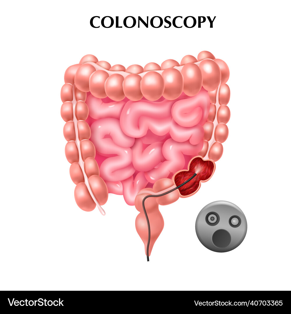 Colonoscopy realistic poster Royalty Free Vector Image