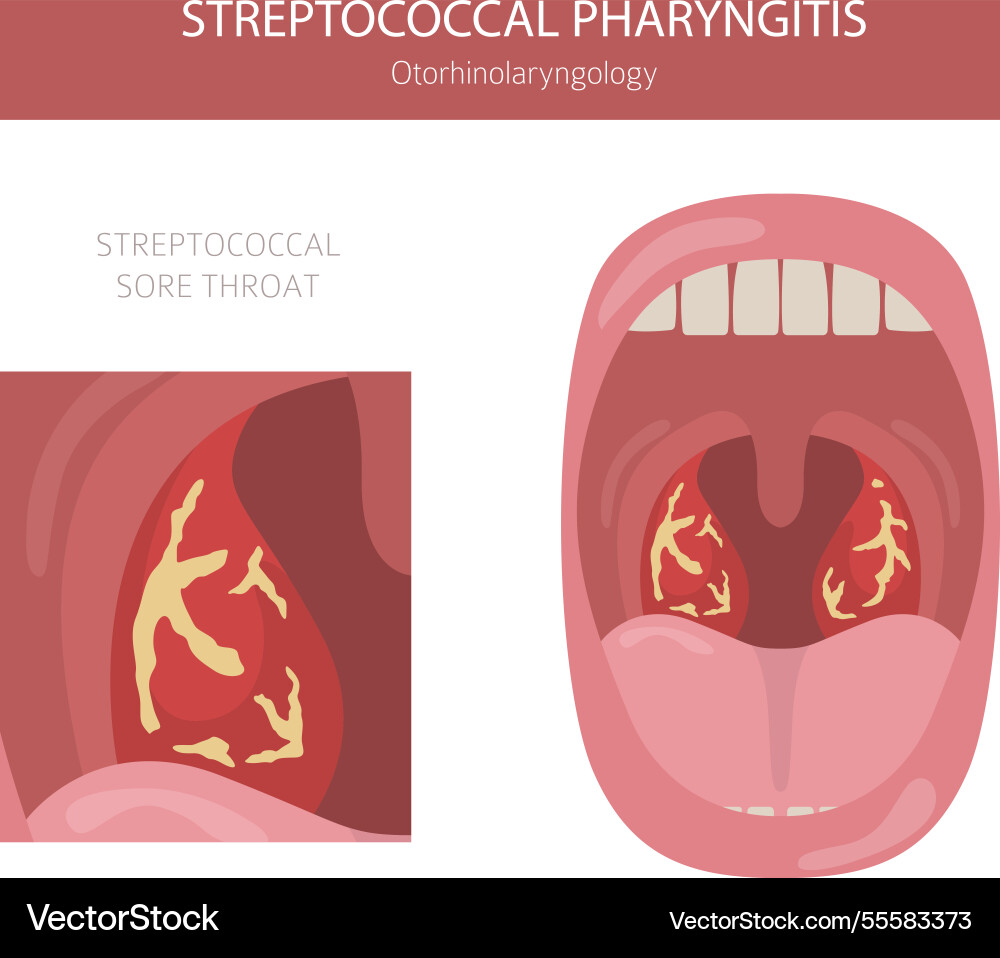 Tonsils and throat diseases streptococcal Vector Image