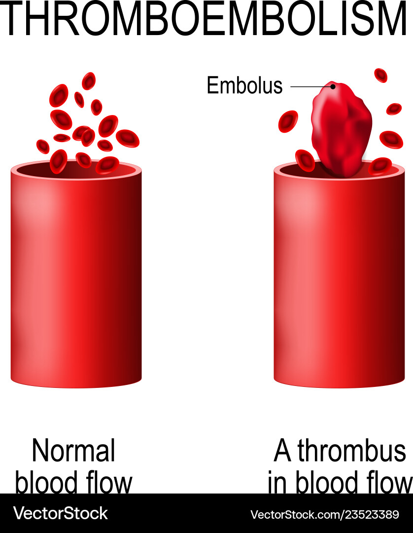 Thromboembolism Royalty Free Vector Image - VectorStock