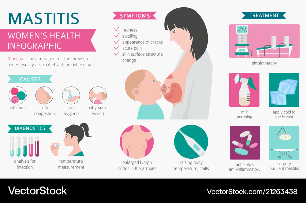 Mastitis breastfeed medical infographic Royalty Free Vector