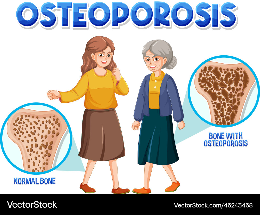 Comparison of normal bone Royalty Free Vector Image
