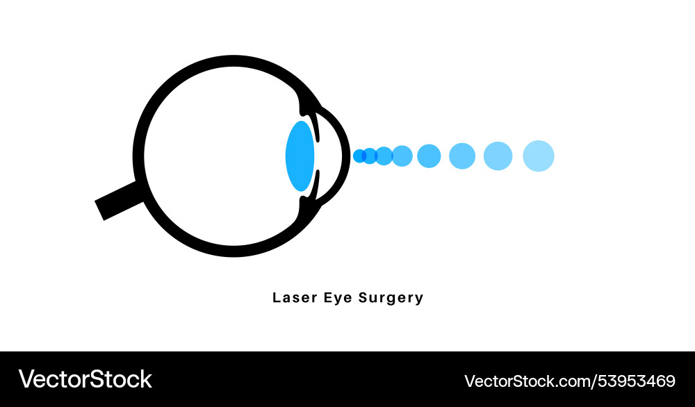 Lasik eye surgery Royalty Free Vector Image - VectorStock