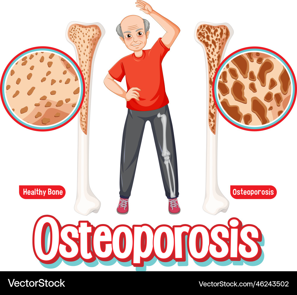 Comparison of normal bone Royalty Free Vector Image
