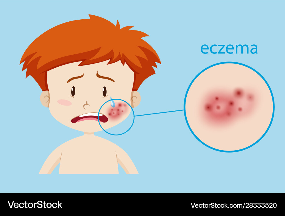 Sick boy with eczema Royalty Free Vector Image