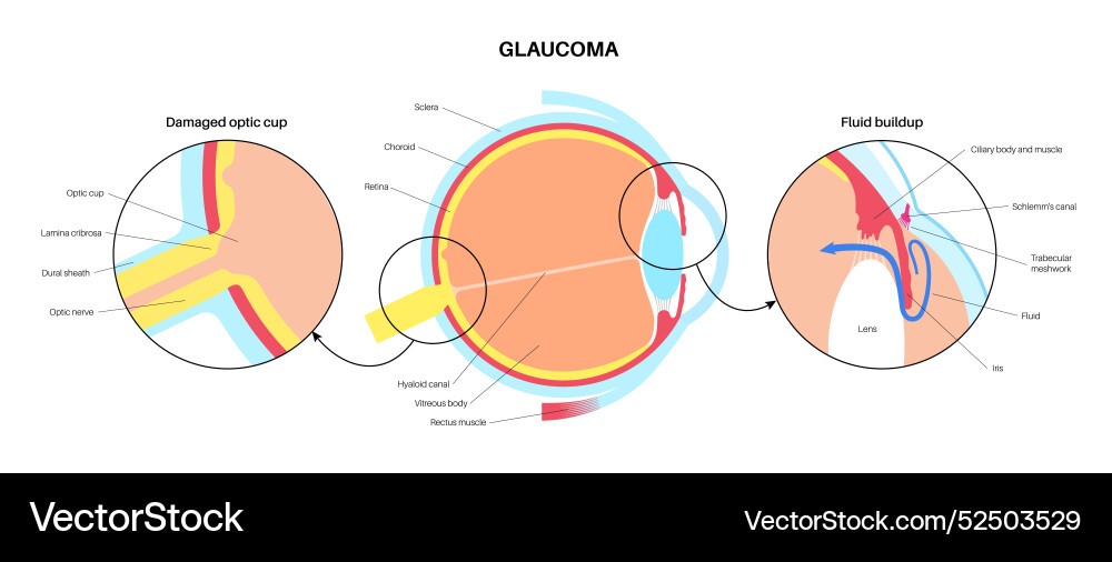 Glaucoma eye disease Royalty Free Vector Image