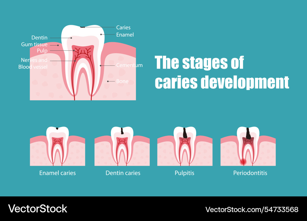 Stages of tooth decay Royalty Free Vector Image