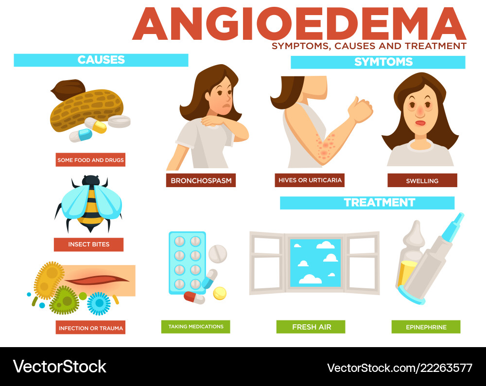 Angioedema Symptoms & Treatment Royalty Free Vector