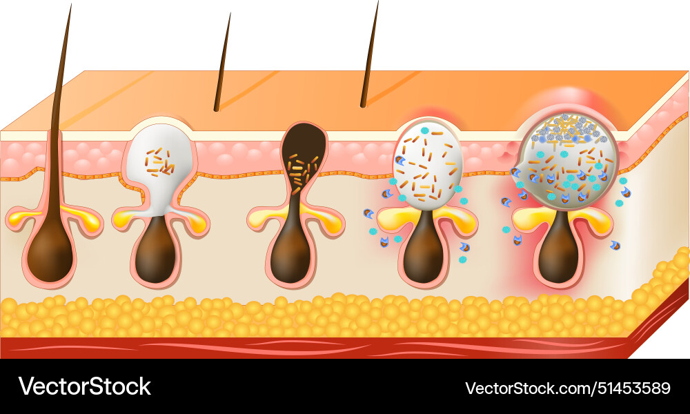 Types of acne pimples Royalty Free Vector Image