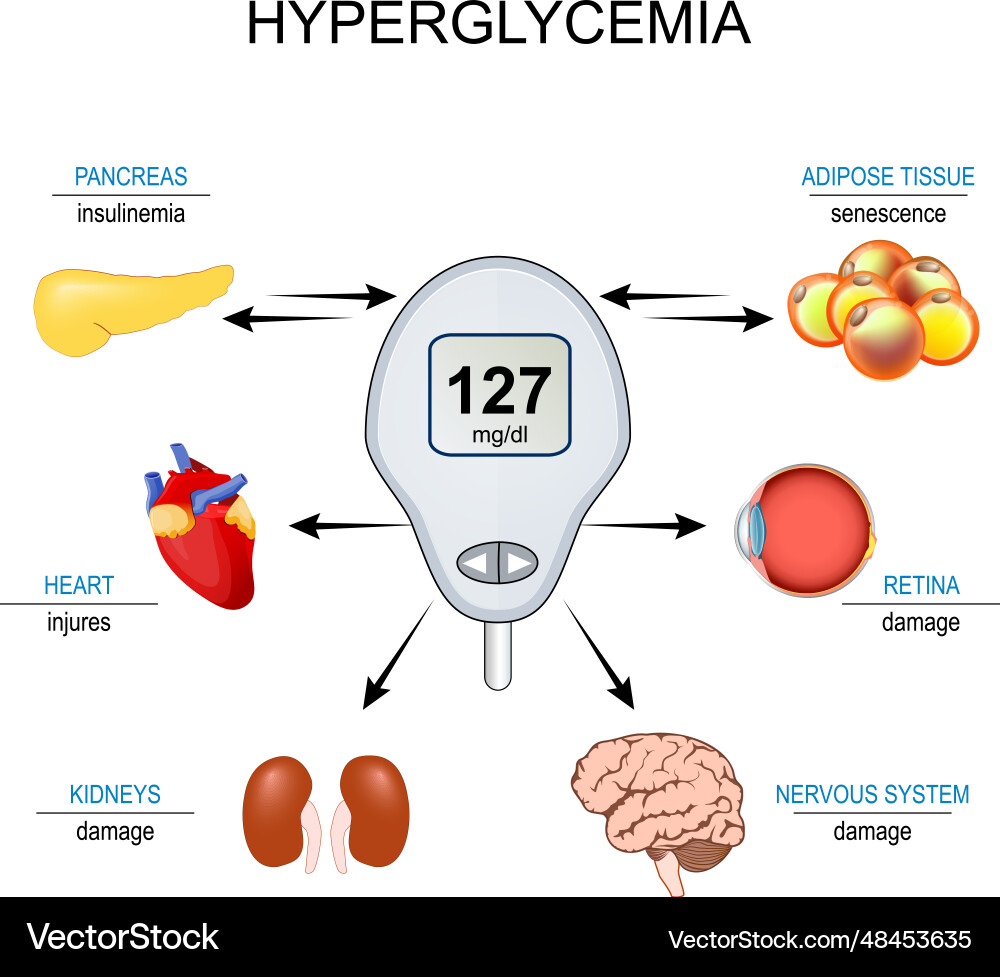Hyperglycemia insulin resistance Royalty Free Vector Image