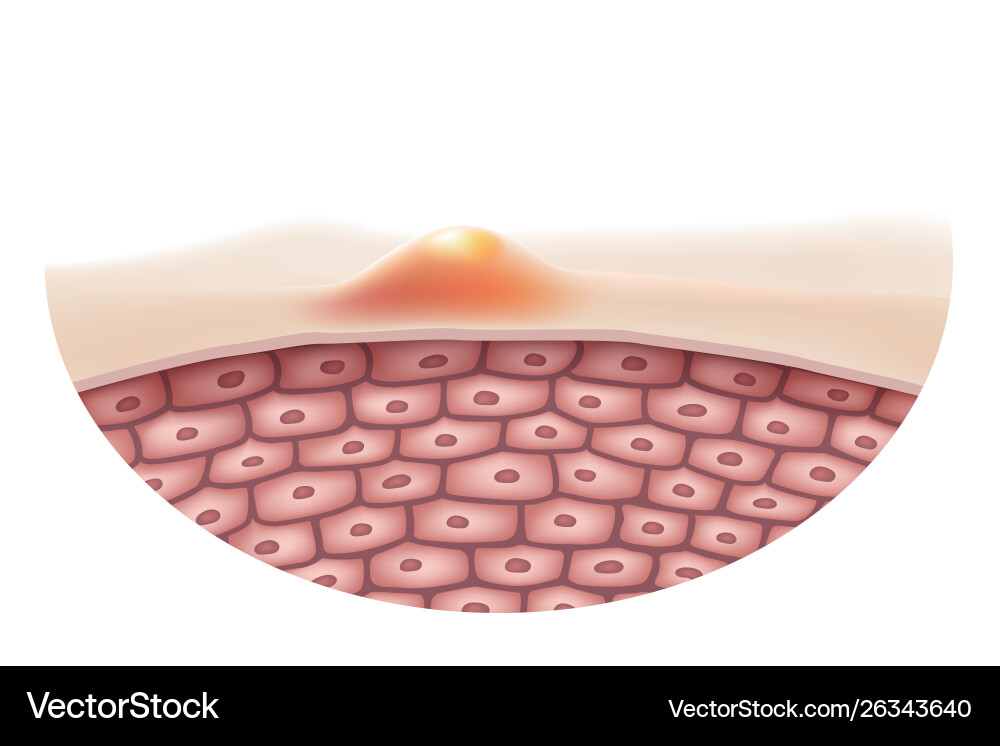 Acne skin Royalty Free Vector Image - VectorStock