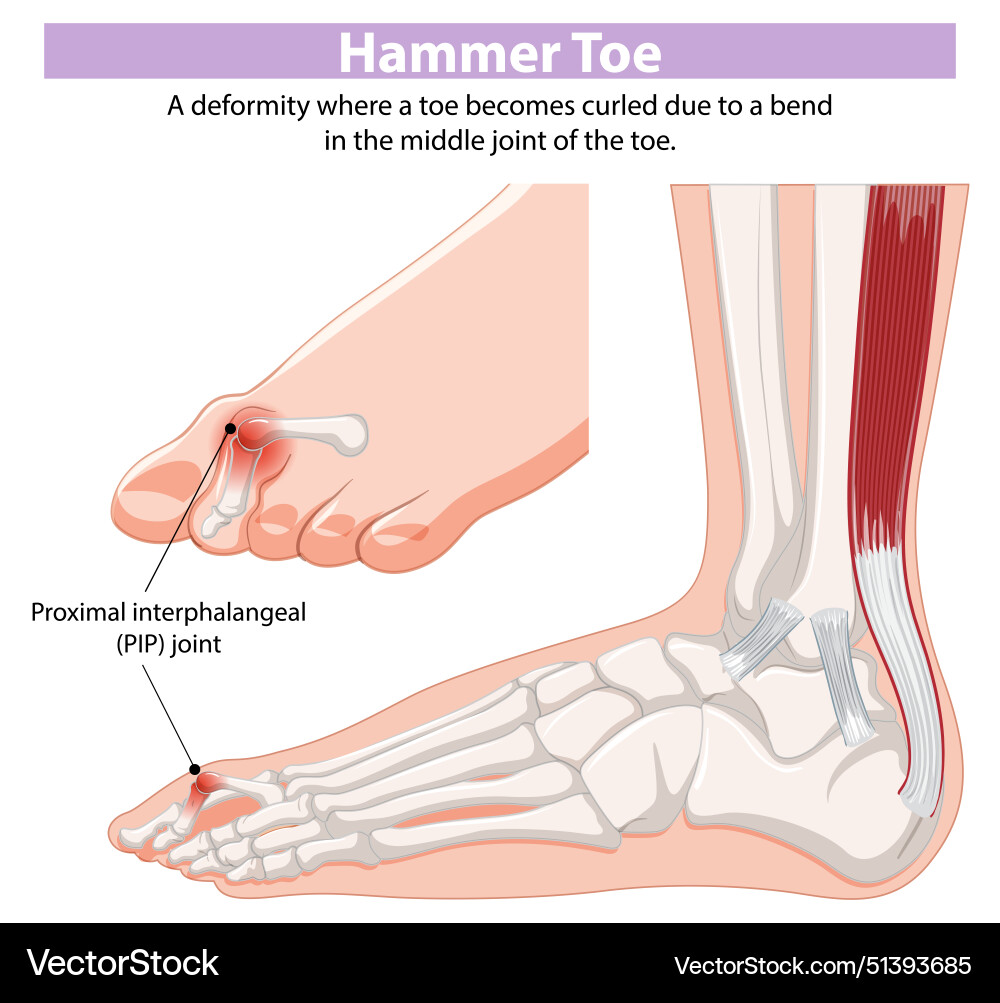 Diagram showing hammer toe deformity and pip joint