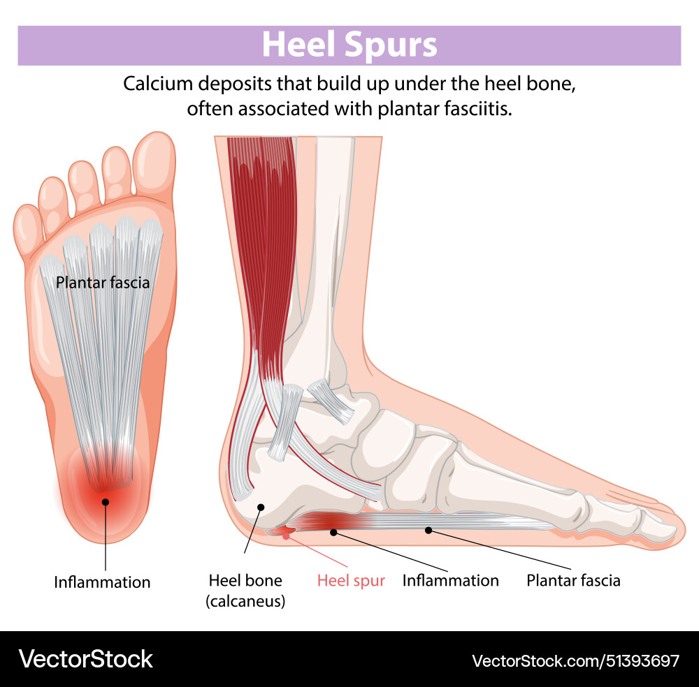 Heel spurs and inflammation Royalty Free Vector Image