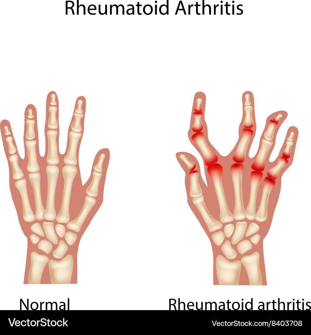 Rheumatoid Arthritis Symptoms Royalty Free Vector Image