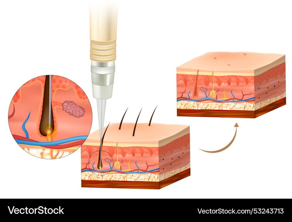 Electrolysis hair removal burning root Royalty Free Vector