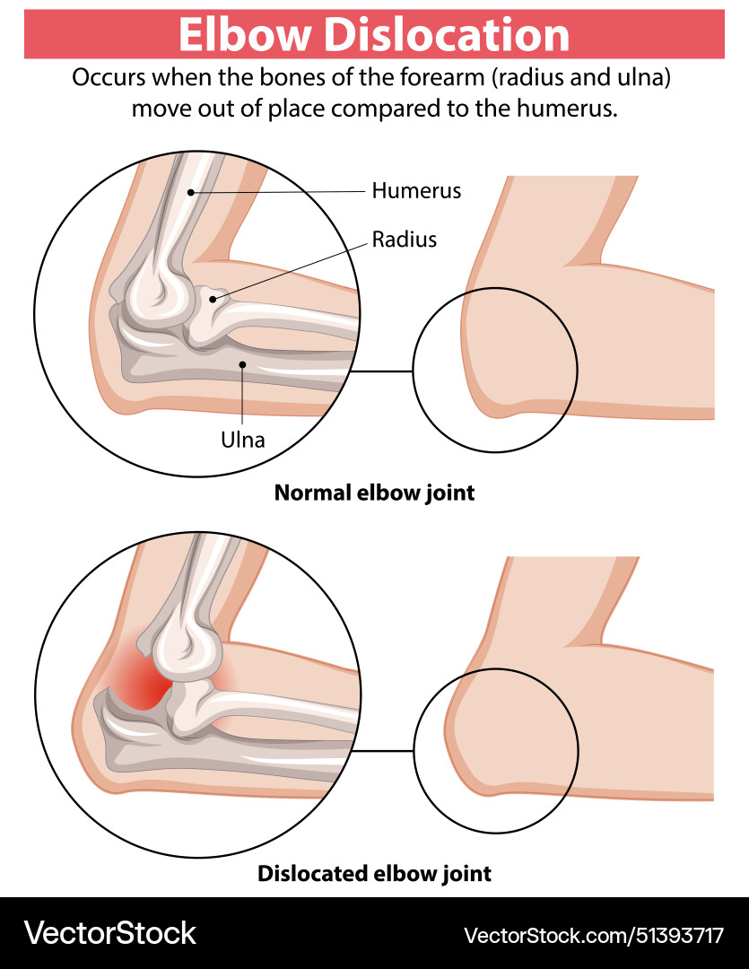 Comparison of normal and dislocated elbow joints Vector Image