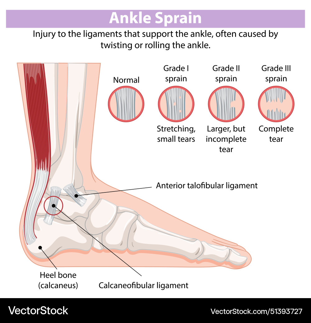 Ankle sprain grades and ligaments Royalty Free Vector Image
