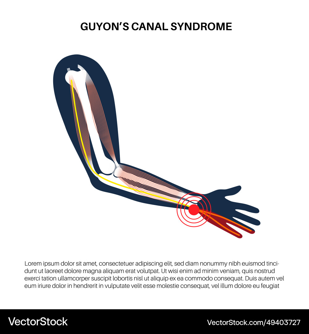 Guyons canal syndrome Royalty Free Vector Image