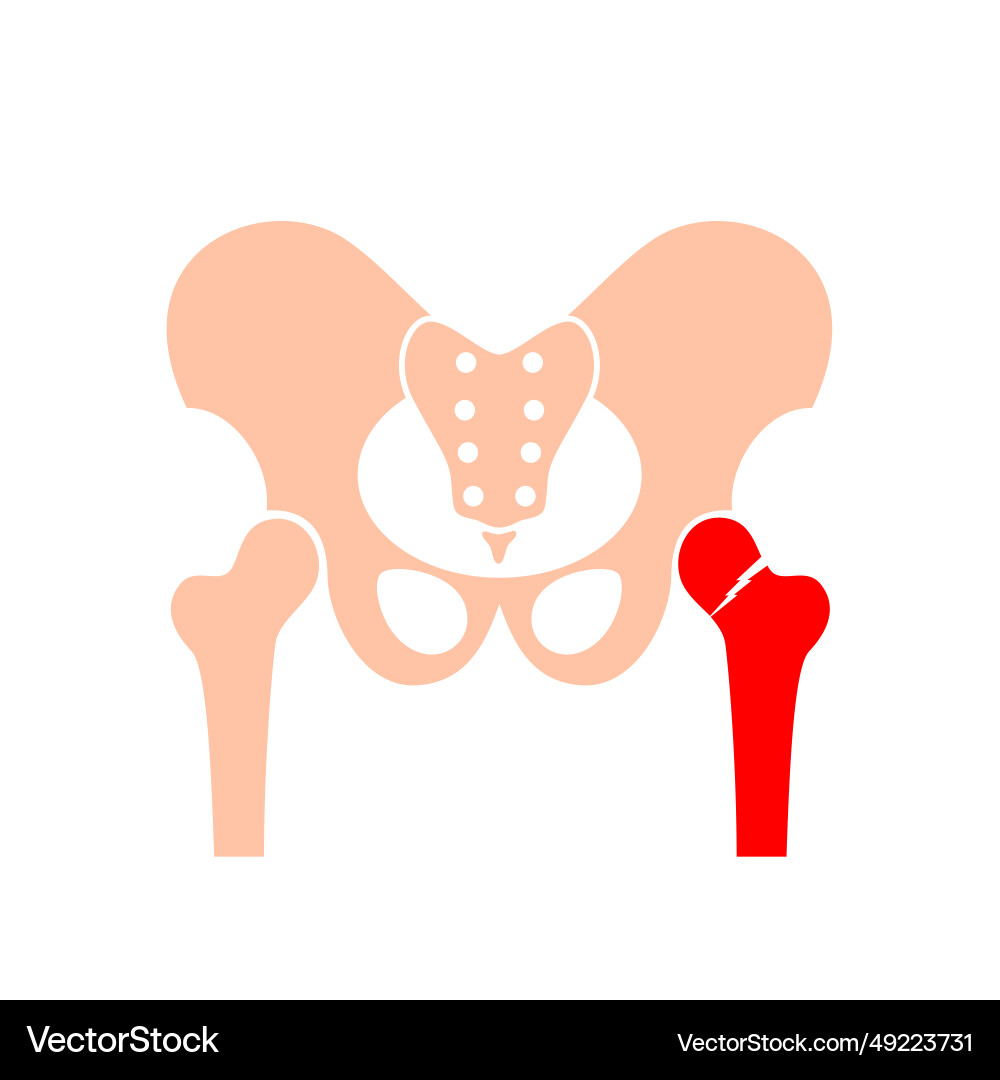 Hip Fracture - Bone Injury Royalty Free Vector Image
