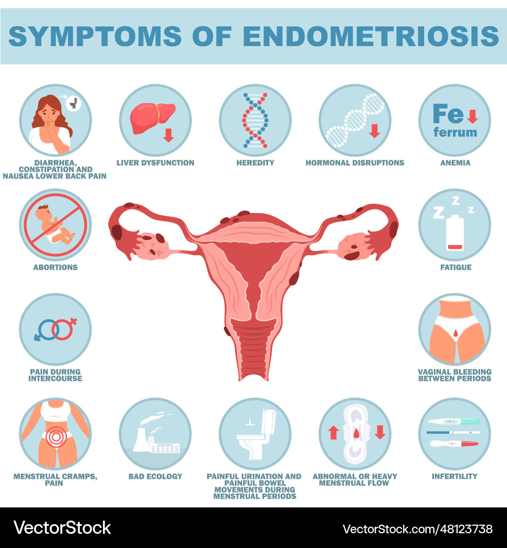 Endometriosis Symptoms & Treatment Royalty Free Vector