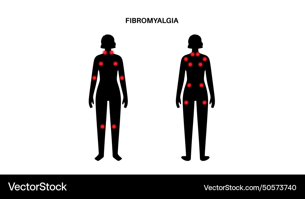 Fibromyalgia medical poster Royalty Free Vector Image