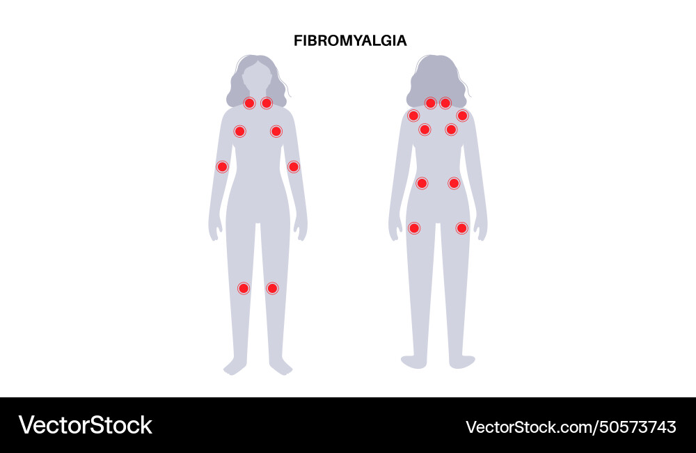 Fibromyalgia medical poster Royalty Free Vector Image
