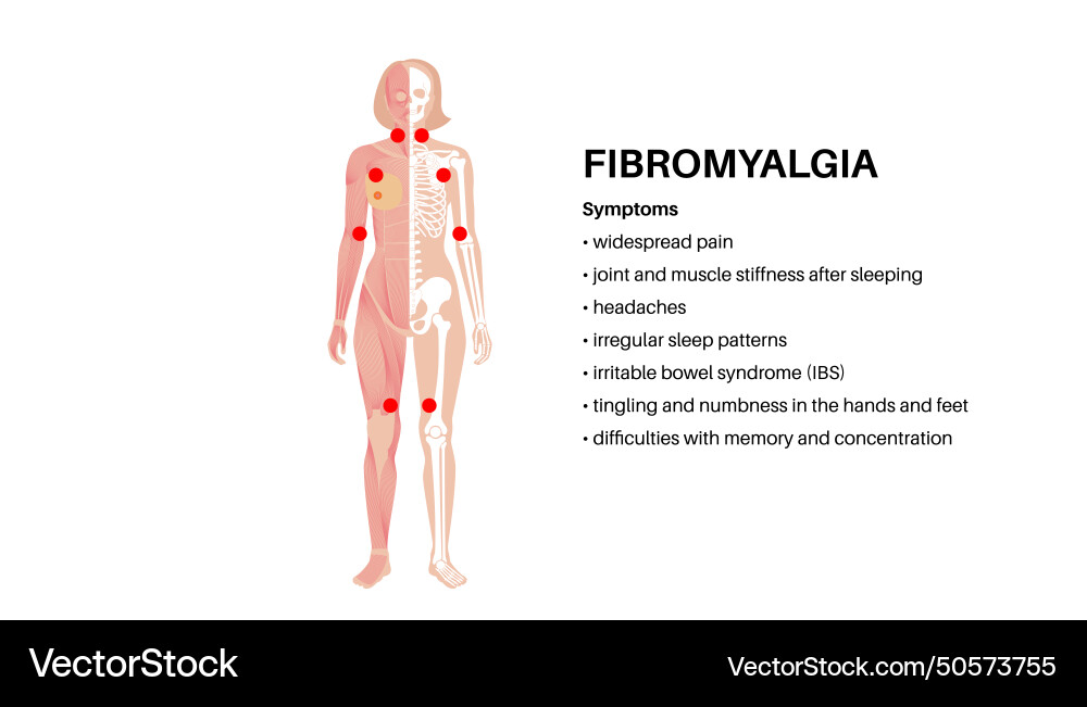 Fibromyalgia medical poster Royalty Free Vector Image