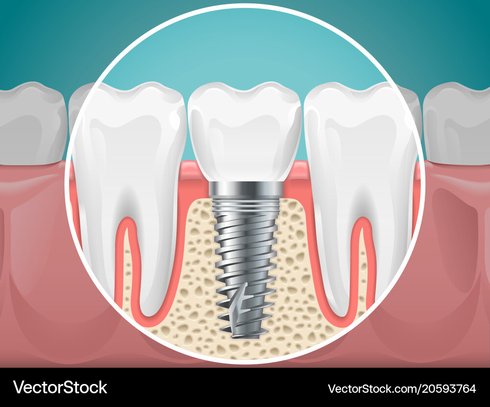 Stomatology dental implants Royalty Free Vector Image