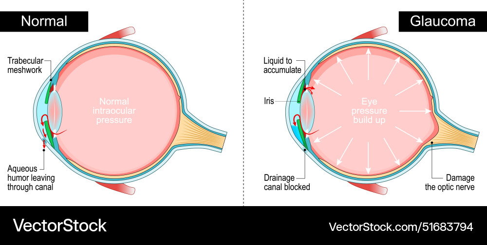 Glaucoma cross section of a human eye Royalty Free Vector