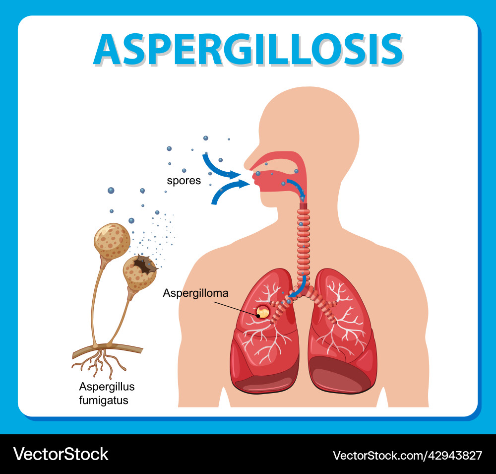 Diagram showing aspergillus infection Royalty Free Vector