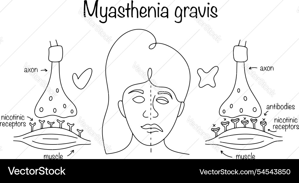 Myasthenia gravis Royalty Free Vector Image - VectorStock