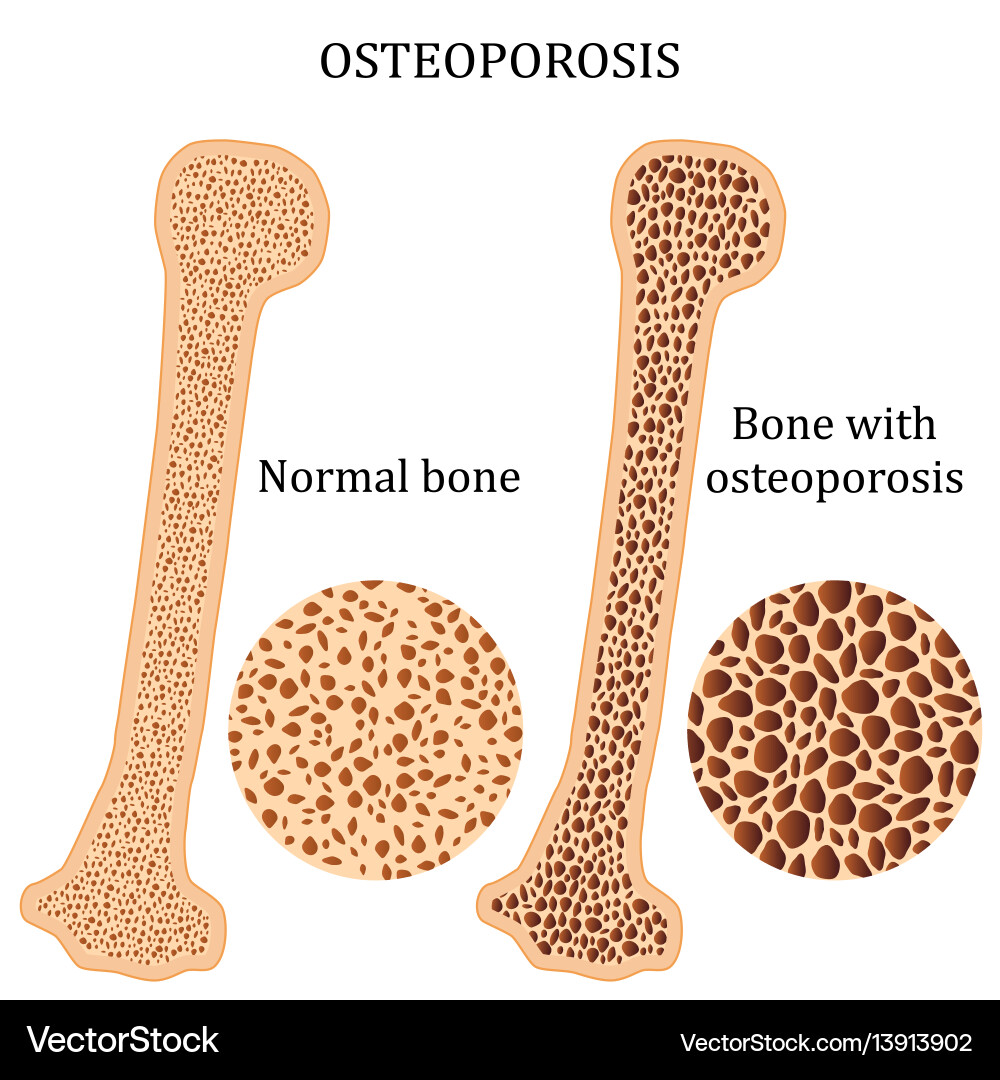 Osteoporosis Comparison: Healthy vs. Degraded Bone