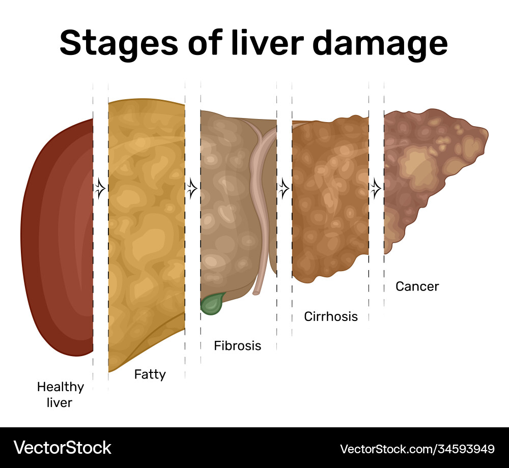 Liver Disease Progression – Royalty-Free Vector | VectorStock