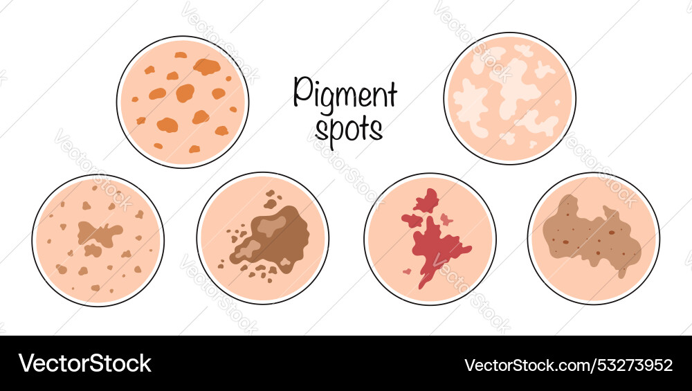 Pigment spots Royalty Free Vector Image - VectorStock