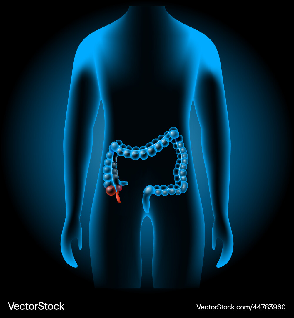 Appendicitis inflammation of the appendix Vector Image Appendicitis inflammation of the appendix Vector Image
