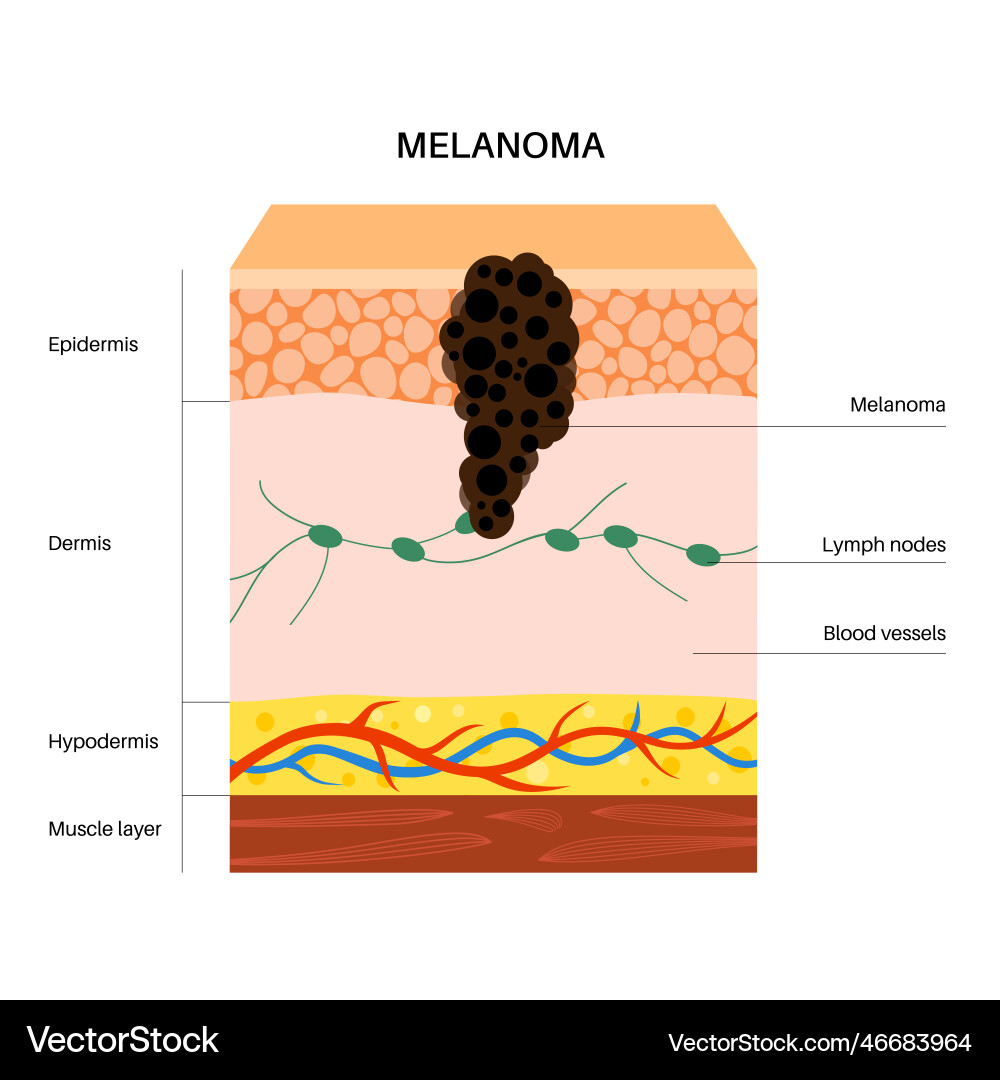 Melanoma Anatomy & Growth Royalty Free Vector Image