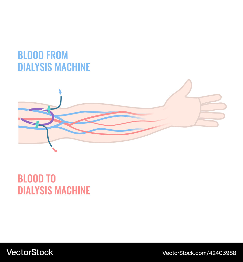 Arteriovenous Access Graft - Hemodialysis Vector Image