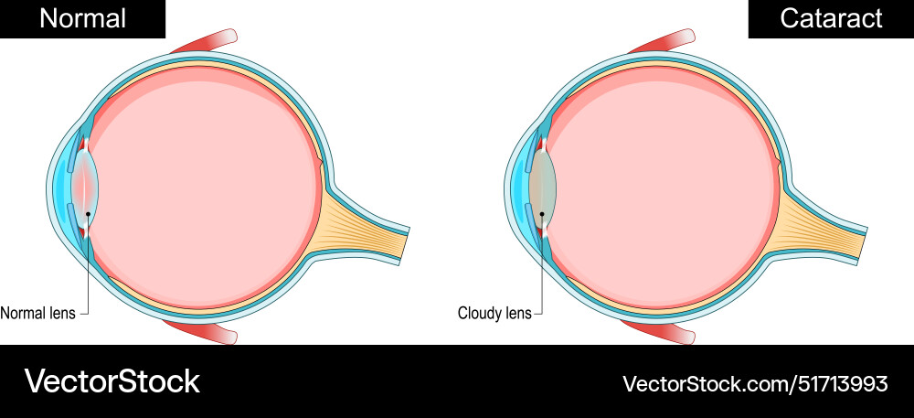 Cataract cross section of a human eye Royalty Free Vector