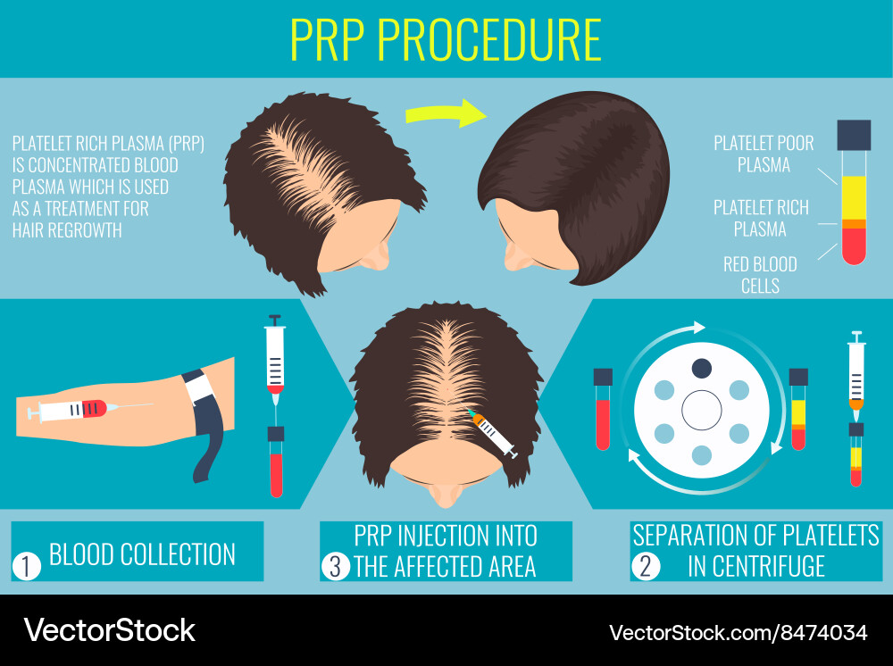 PRP Hair Restoration Treatment Royalty Free Vector Image