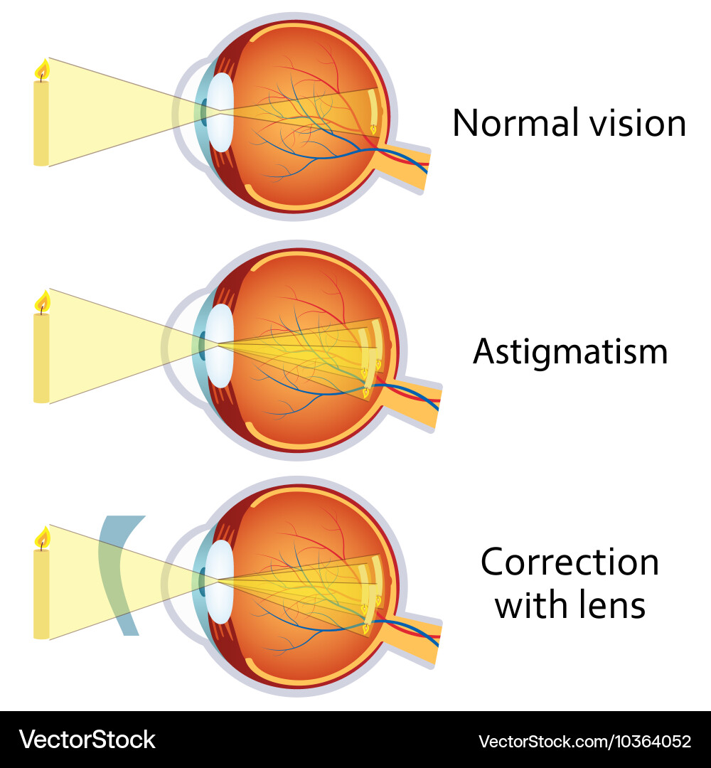Astigmatism corrected by a cylindrical lens Vector Image