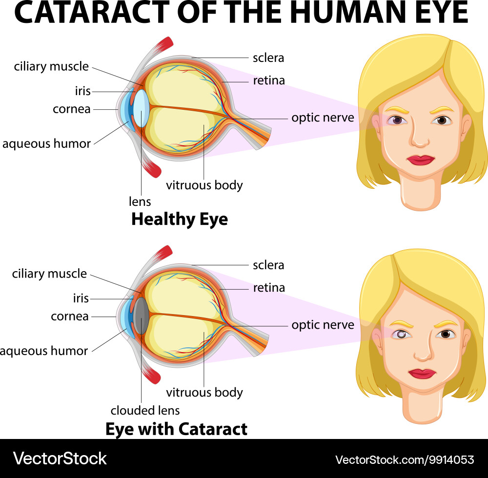 Diagram showing eyes with cataract Royalty Free Vector Image
