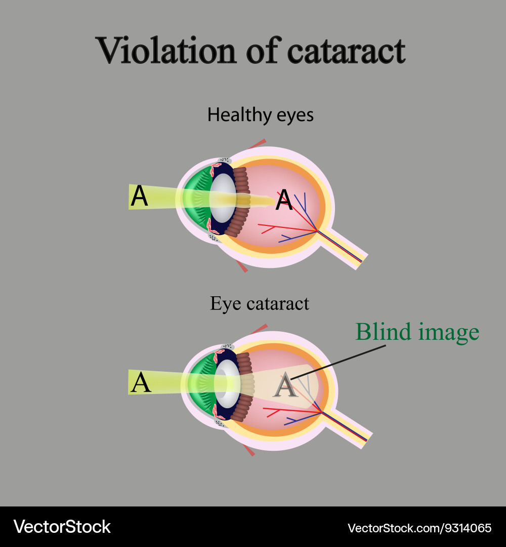 Structure of the eye cataracts Royalty Free Vector Image