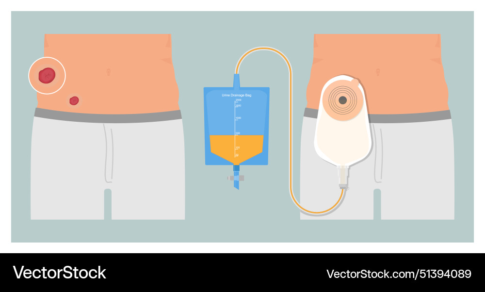 Stoma and colostomy Royalty Free Vector Image - VectorStock
