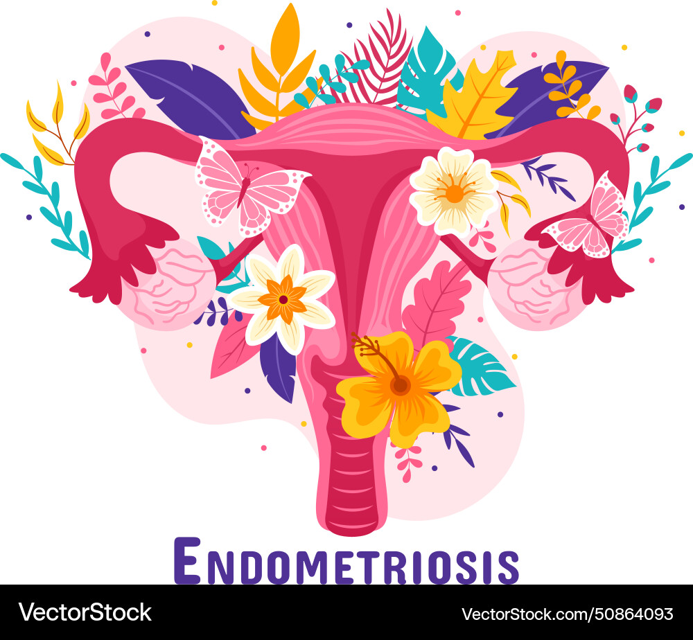 Endometriosis with condition the endometrium Vector Image