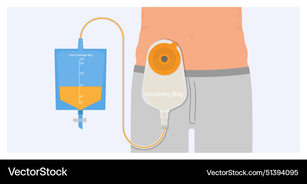 Urostomy bag containing urine flow through small Vector Image