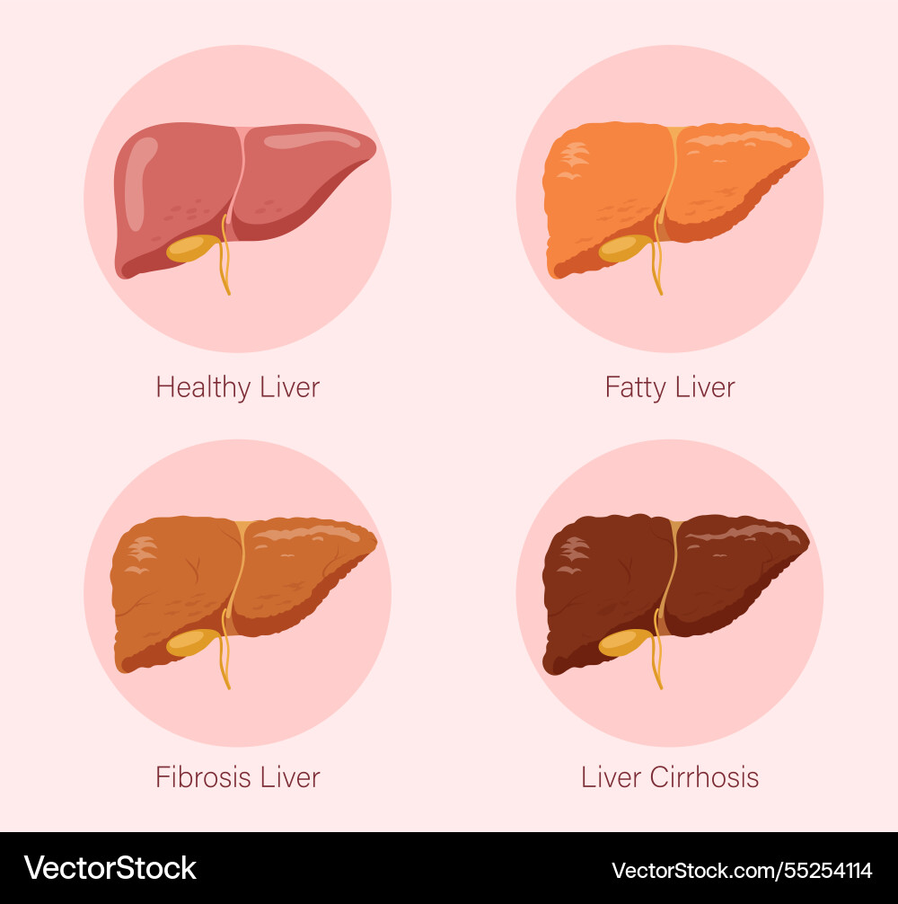 Liver health stages Royalty Free Vector Image - VectorStock